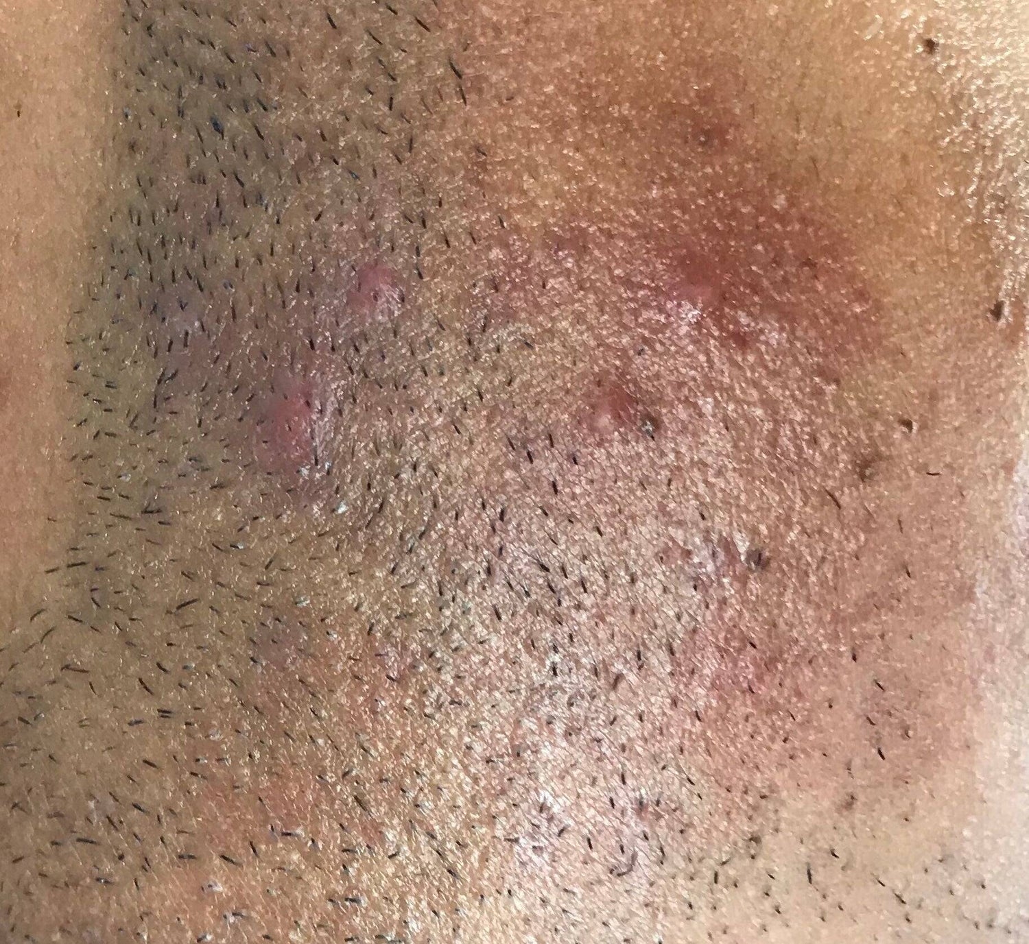 3 Common Skin Issues With Oily Skin: Blackheads, Breakouts, and Blemis ...